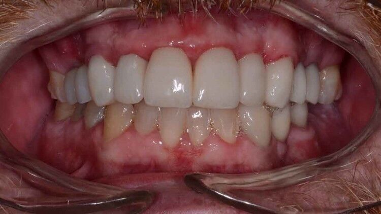 The Science Behind Invisalign: How Clear Aligners Straighten Your Teeth - My Plantation Dentist